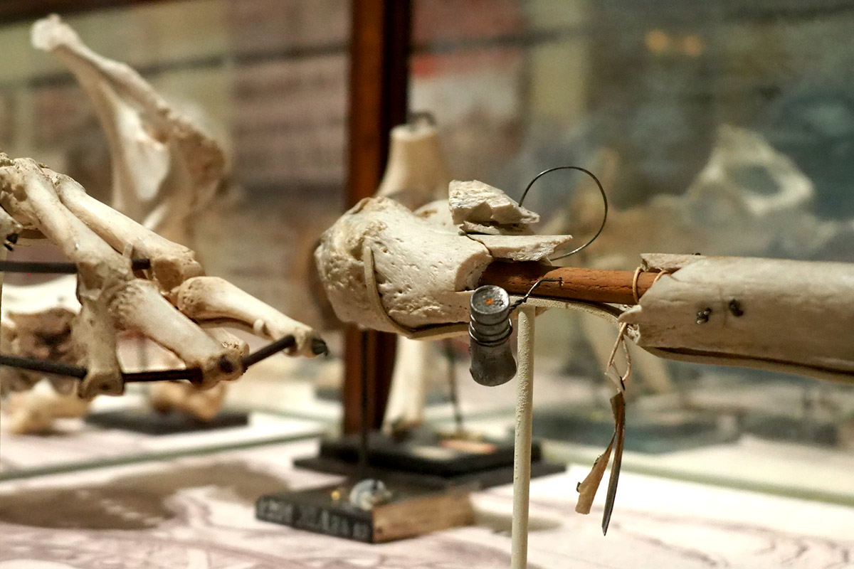 Civil War at Philadelphia's Mütter: Shattered Bodies, Shallow Graves ...